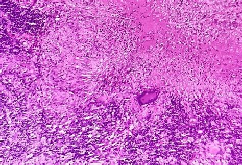 Low Power View Showing Caseating Granulomatous Lymphadenitis Hande 10x