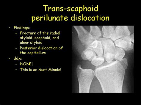 Anterior Shoulder Dislocation Findings Inferomedial Subcoracoid