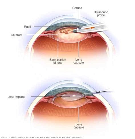 When Can I Wear Eye Makeup After Cataract Surgery My Glow Journey