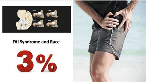 Fai Syndrome Is A Leading Cause Of Hip Pain In Fact It Is Present In