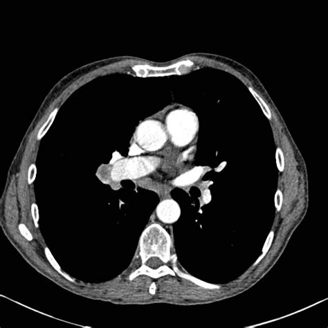 Radiopaedia Case Hilar Mass The Value Of Interval Imaging Id 56830
