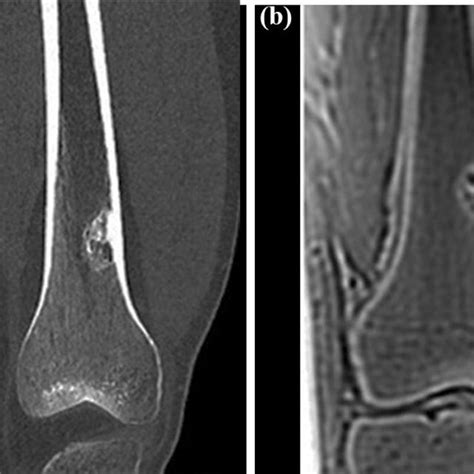 Histologically Confirmed Non Ossifying Fibroma Of The Right Lower Femur