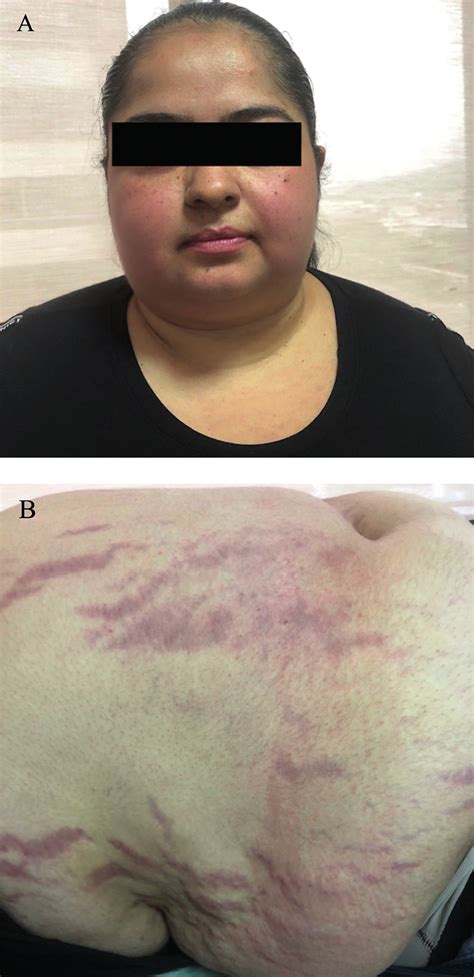 Manifestaciones Clínicas Del Síndrome De Cushing Paciente Con Pénfigo