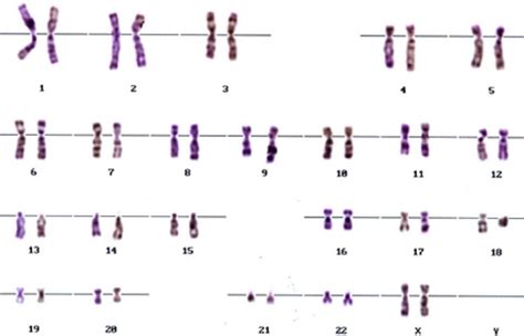 Dwarfism Karyotype Analysis Of The Clinical And Molecular