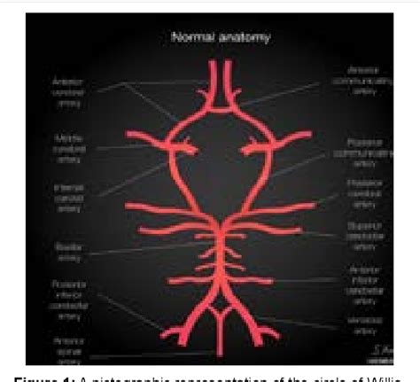 Figure 1 From Basilar Artery Hypoplasia With Embryonic Origin Of