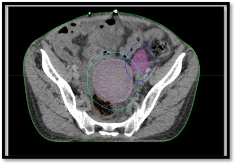 Hemostatic Pelvic Irradiation A Rarely Reported Approach To Benign