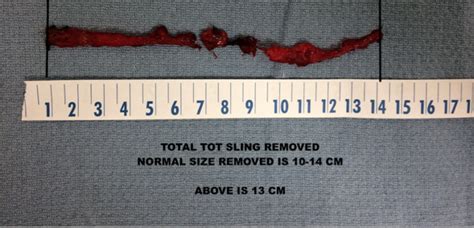 Pelvic Mesh Complications Miklos And Moore Urogynecology