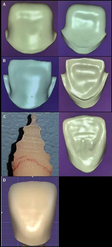 framework designs using exocad software a simple core design buccal