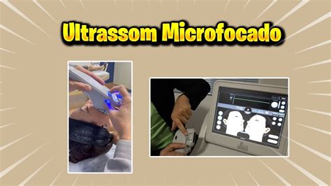 Entenda Sobre O Ultrassom Microfocado Youtube