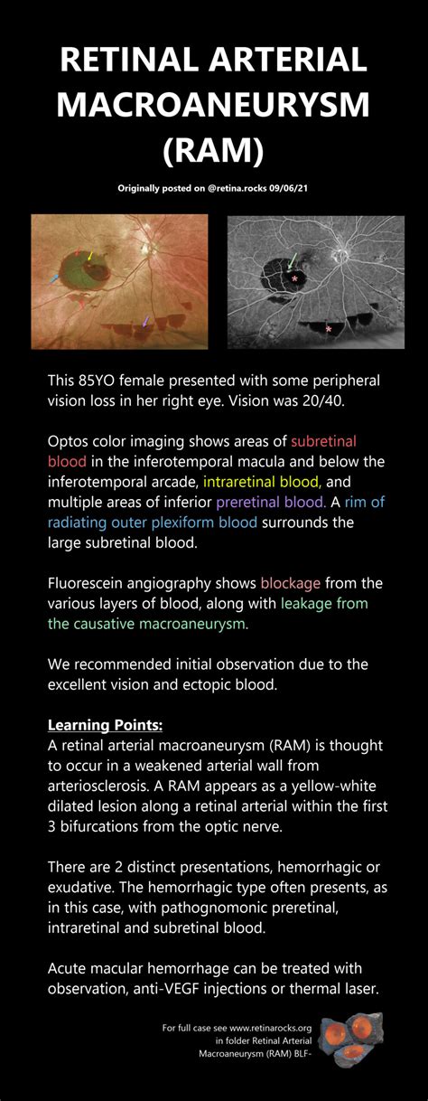 Retinal Vascular Disorders Misc Retinal Arterial Macroaneurysm Ram Retina Rocks