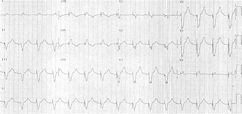 Pacemaker Rhythms Normal Patterns Litfl Ecg Library Diagnosis