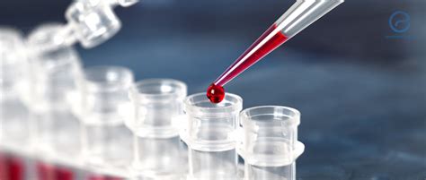 High Mobility Group Box 1 Expression Could Lead To Disease Progression