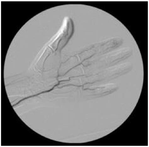 Angiogram After 20 H Of Thrombolytic Infusion Revealing Complete