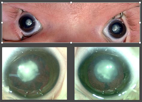 Cataract Surgery Eye Blurry At David Sells Blog