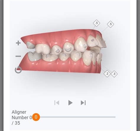 Can You Check My Invisalign Clincheck R Invisalign