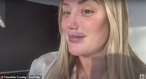 Charlotte Crosby Displays Bruised Lips After Getting Filler Dissolved