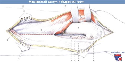 Техника медиального доступа к бедренной кости