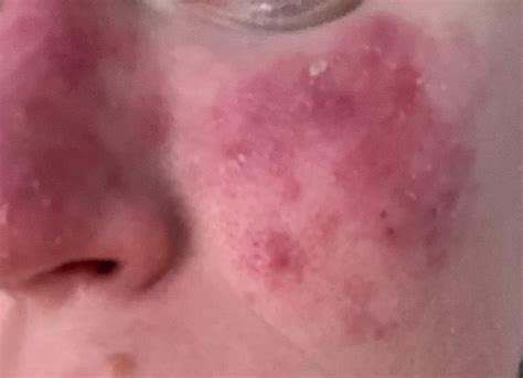 Rosacea Seborrheic Dermatitis Rrosacea