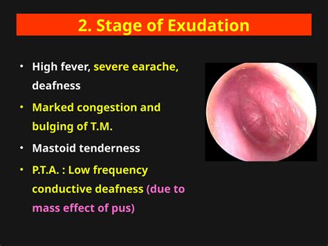 Acute Suppurative Otitis Media And Acute Mastoiditis Kk Ppt