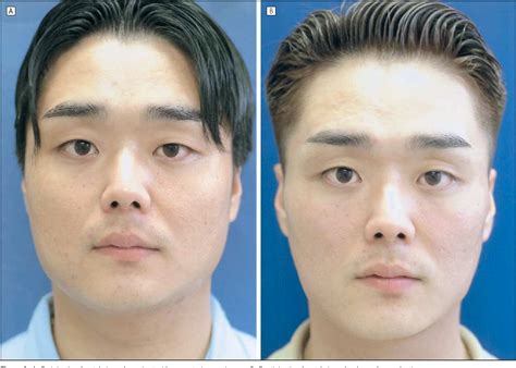 Masseter Botox