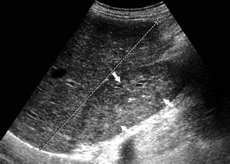 Us Image Shows Diffuse Increase In Renal Echogenicity Similar To That