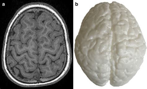 The Normal Cortex Of The Brain In A 5 Year 8 Month Old Girl Presenting