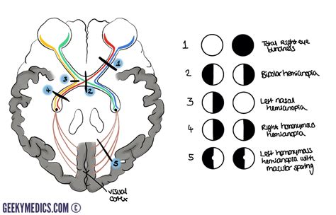 Visual Field Defects Geeky Medics