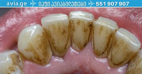 მარტივი გზა სტომატოლოგთან ვიზიტის გარეშე კბილის ქვის მოსაშორებლად Vap Ge