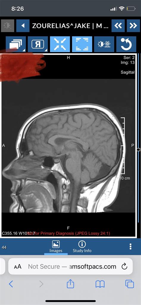 Wondering If This Looks Like Chiari R Chiari