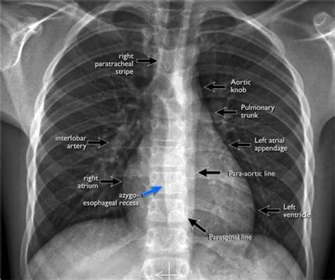 Radiology Assistant Chest X Ray CXR Flashcards Radiology