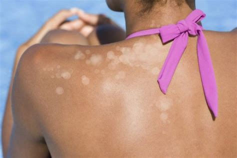 Why Do You Get White Spots From Tanning New Health Advisor