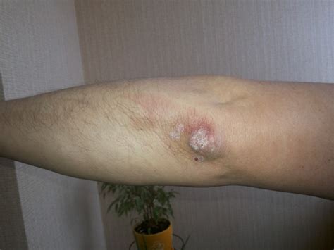 Как я живу и борюсь с псориазом на локтях