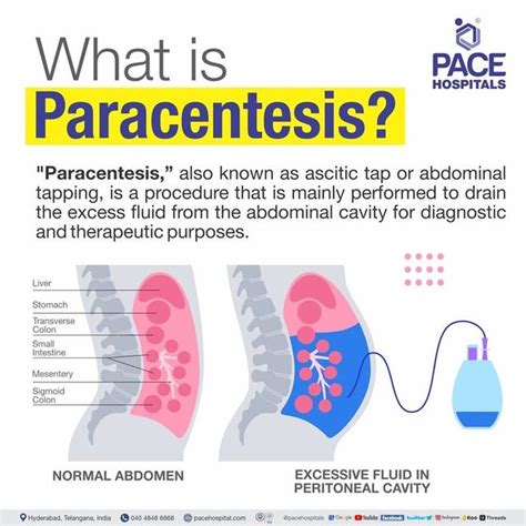 Paracentesis Position Paracentesis Procedure