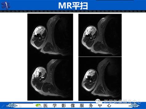 病例学习软组织内恶性孤立性纤维肉瘤一例 影像PPT