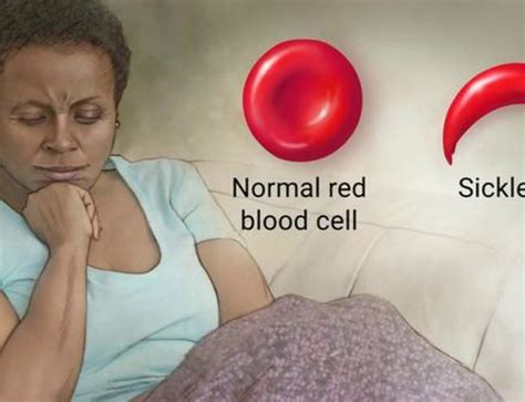 Sickle Cell Anemia Archives Almurshidi Medical Tourism Best