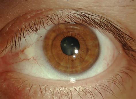 Custom Vs Standard Soft Lenses For The Irregular Cornea How To Choose