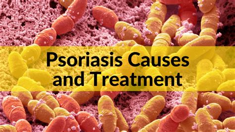 Understanding Tremfya A Breakthrough In Plaque Psoriasis Treatment