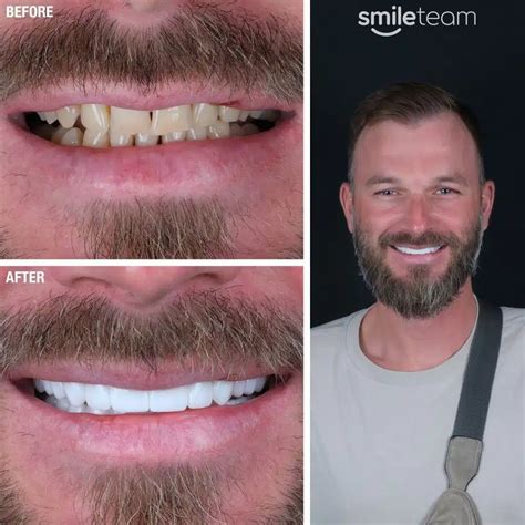 Turkey Teeth Before After Photos Smile Team Turkey