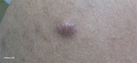 Worried About His Bump Help Rmelanoma