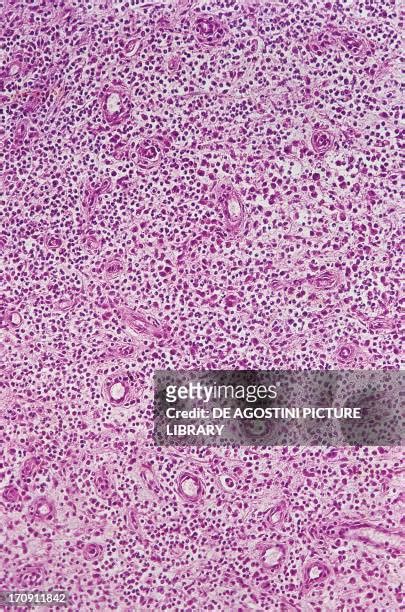 Granulation Tissue Photos And Premium High Res Pictures Getty Images