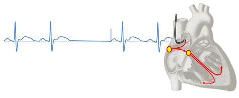 Single And Dual Chamber Pacing Modes Deranged Physiology