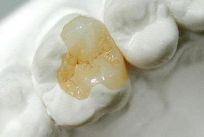 补牙挂什么科 爱康健齿科