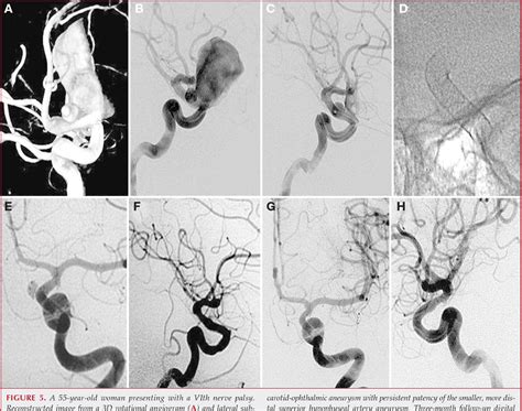 Figure 1 From Curative Endovascular Reconstruction Of Cerebral Aneurysms With The Pipeline