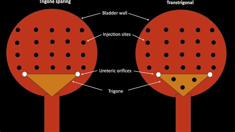 Free Clip From Video Intravesical Botox Injection Bjui