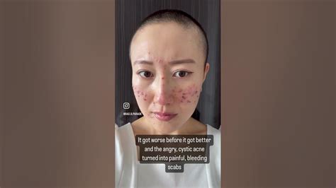 Breast Cancer Side Effects Chemo Acne Youtube