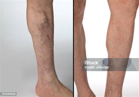 사페누스 정맥 역류 수술 전후 종아리 왼쪽 하지정맥류에 대한 스톡 사진 및 기타 이미지 하지정맥류 건강관리와 의술 수술
