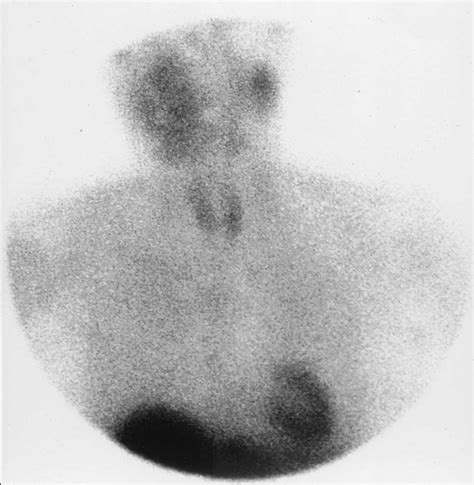 Postperative 99m Tc Mibi Nuclear Scan Revealing No Focus Of Increased