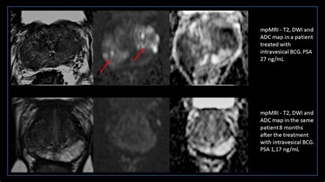 Granulomatous Prostatitis A 60 Year Old Patient Treated With