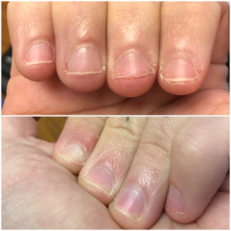Shiny Nail Fold That Easily Looks Wrinkled R Scleroderma