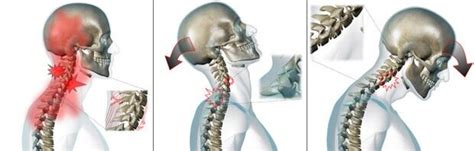 Whiplash Injury After A Motor Vehicle Accident — Sydney Health